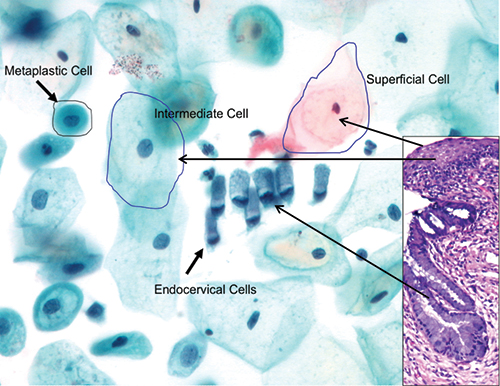PAP Smear Screening - The CRUDEM Foundation, Inc