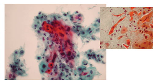 PAP Smear Screening - The CRUDEM Foundation, Inc